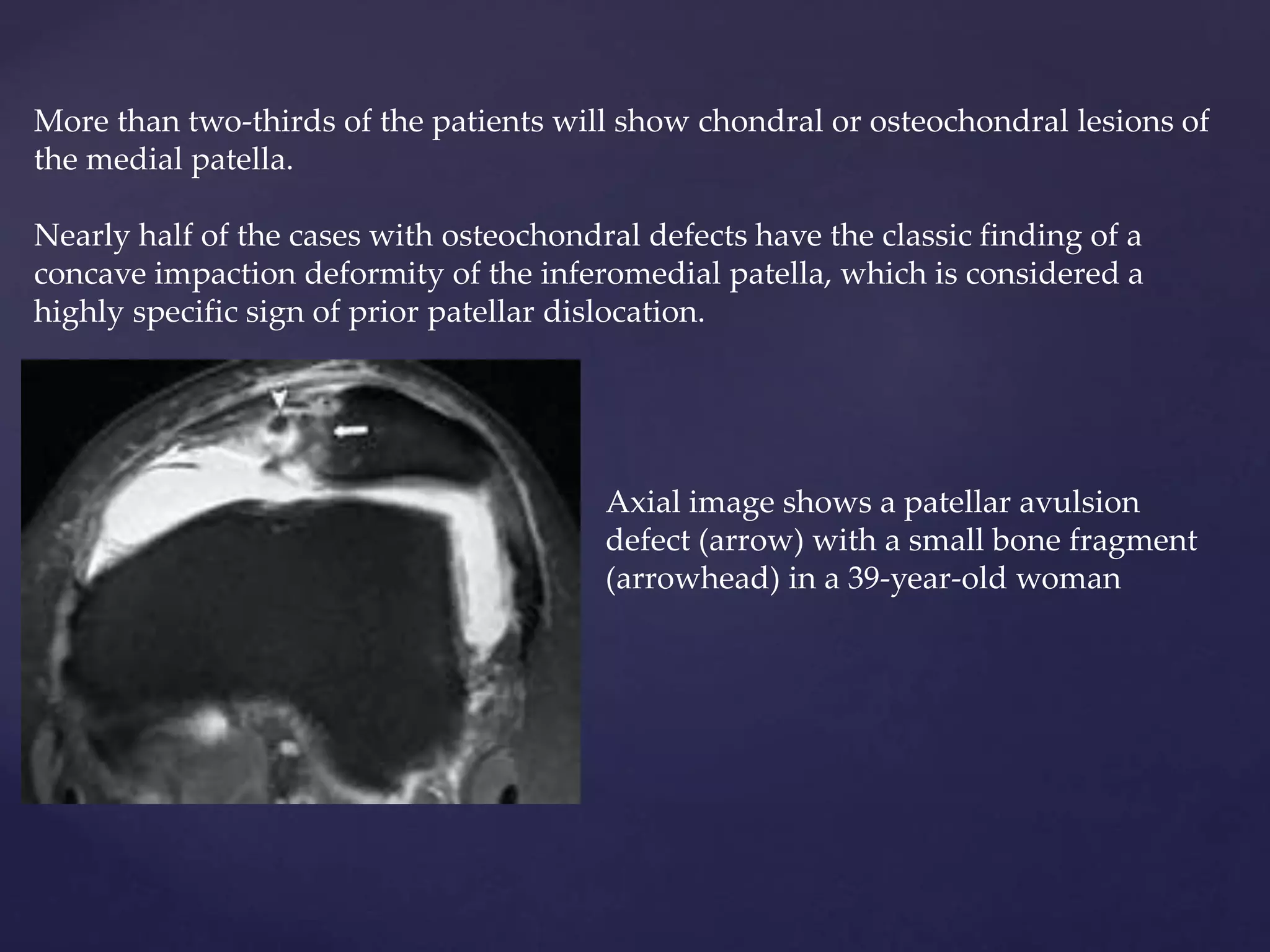 Patello femoral joint - MRI | PPTX