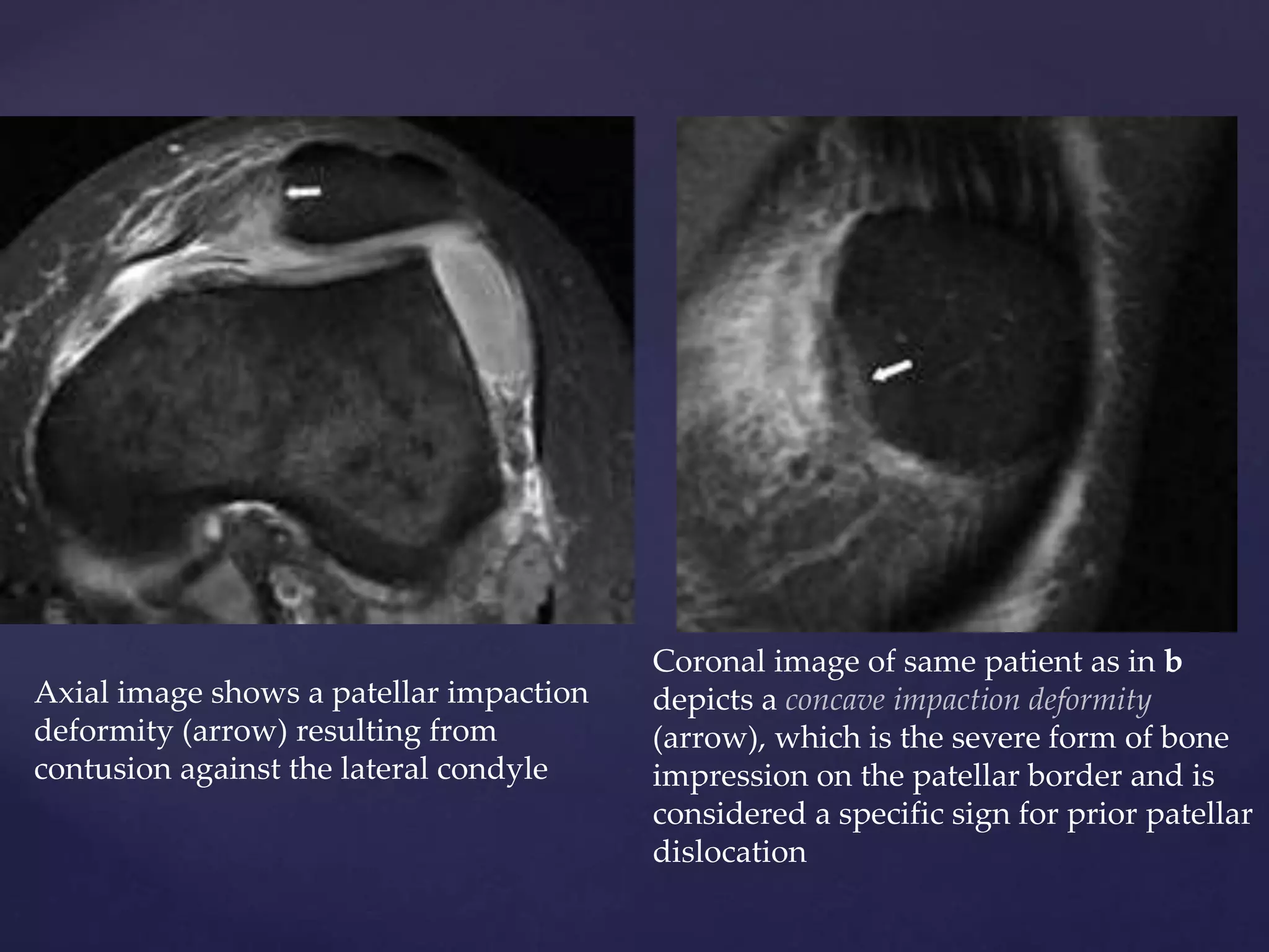 Patello femoral joint - MRI | PPTX