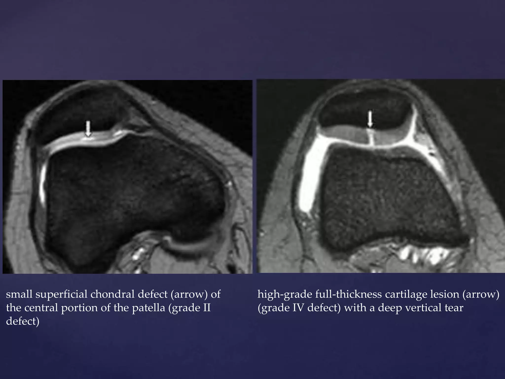 Patello femoral joint - MRI | PPTX