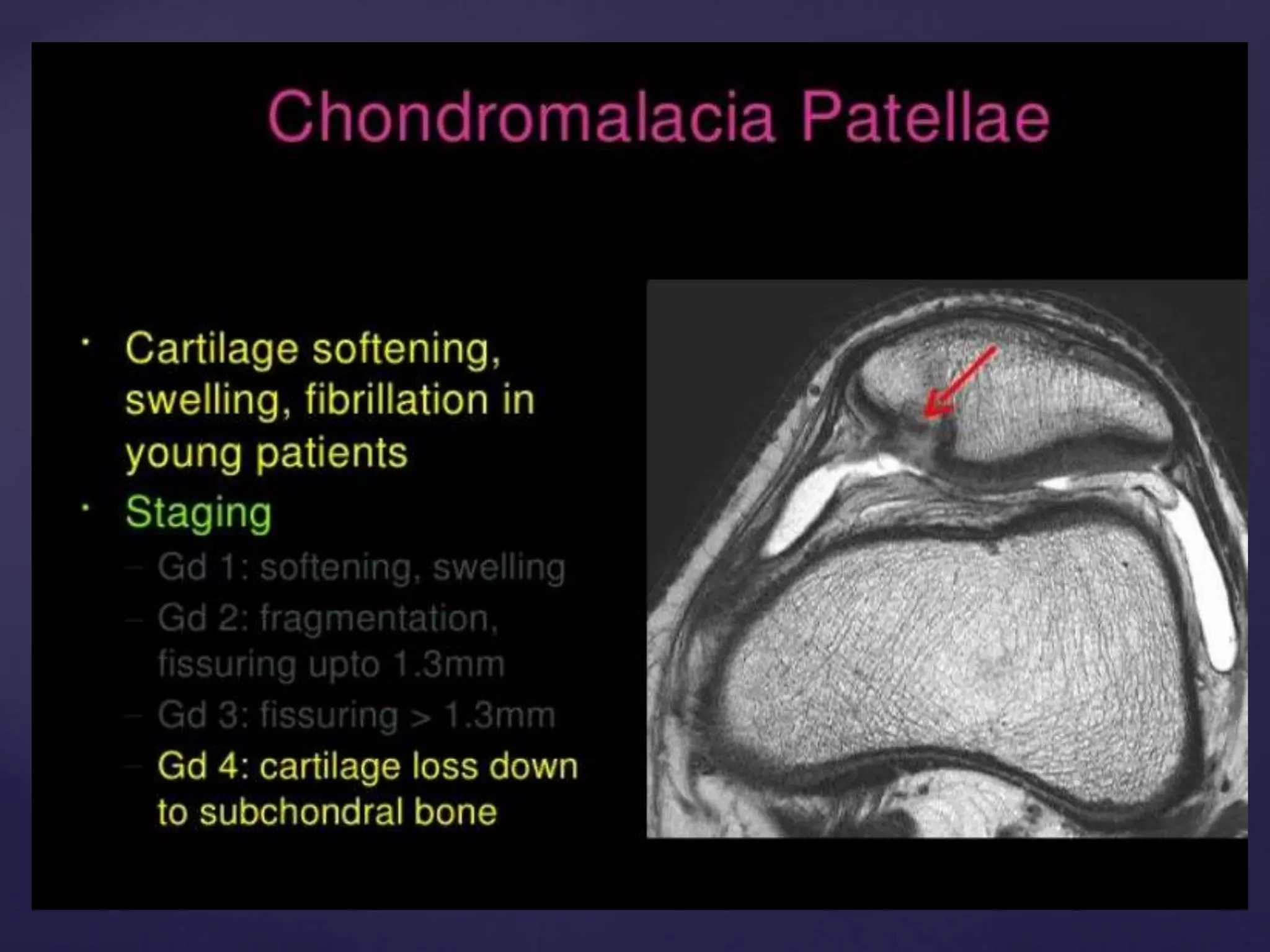 Patello femoral joint - MRI | PPTX