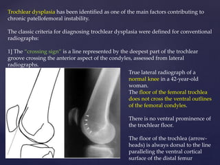 Patello femoral joint - MRI | PPTX