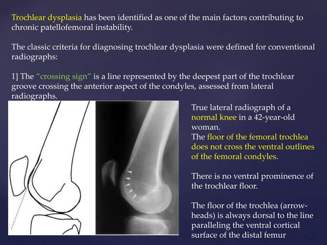 Patello femoral joint - MRI | PPTX