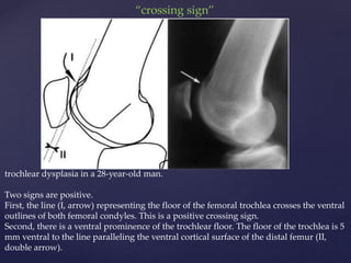 Patello femoral joint - MRI | PPTX