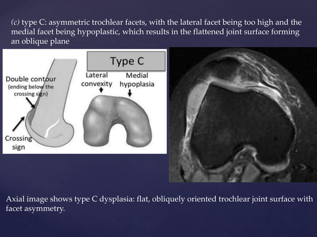 Patello femoral joint - MRI | PPTX