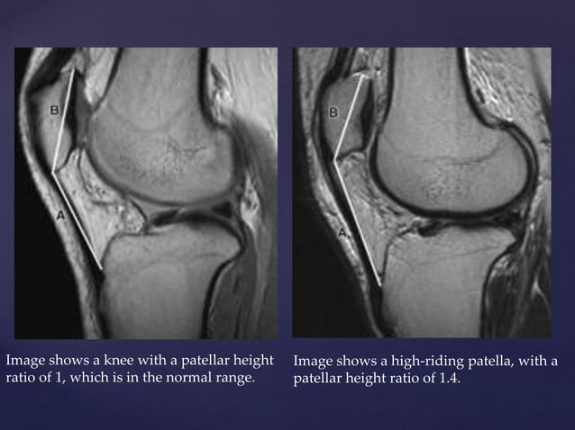Patello femoral joint - MRI | PPTX