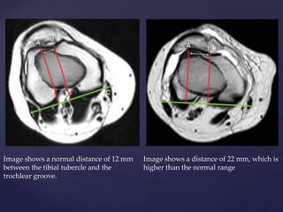 Patello femoral joint - MRI | PPTX