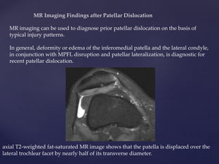 Patello femoral joint - MRI | PPTX