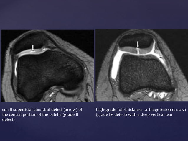 Patello femoral joint - MRI | PPT