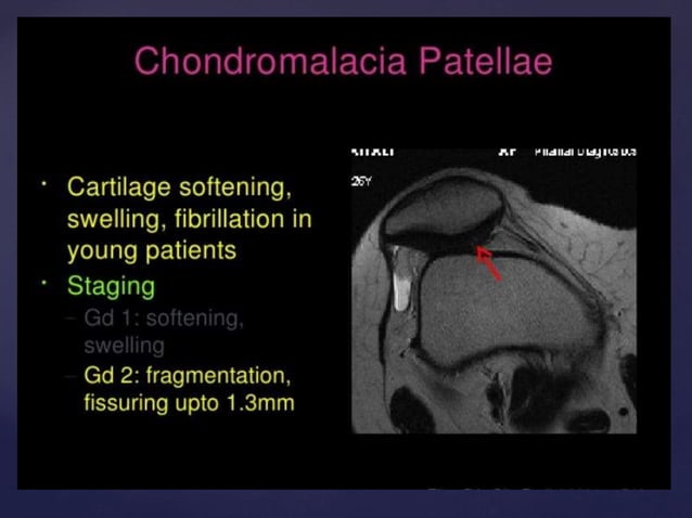 Patello femoral joint - MRI | PPTX