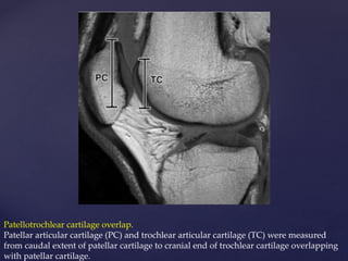 Patello femoral joint - MRI | PPTX