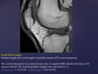 Patello femoral joint - MRI | PPTX