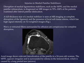 Medial Patellar Retinaculum Mri