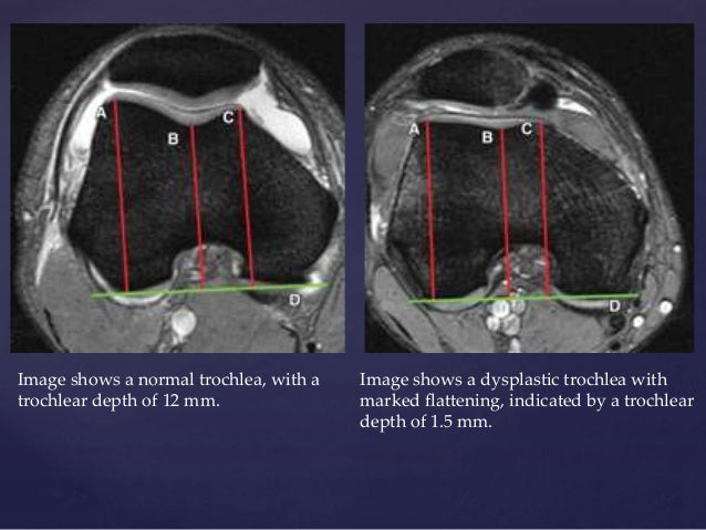 Patello femoral joint - MRI