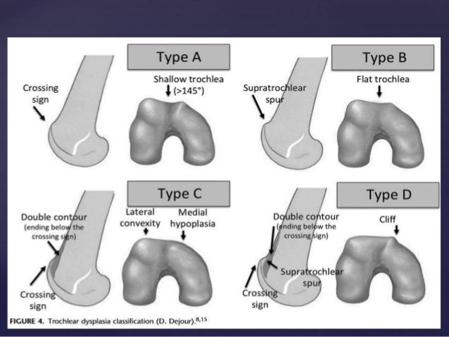 Patello femoral joint - MRI