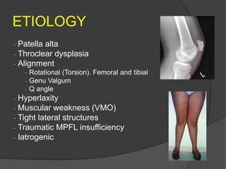 Patellofemoral instability | PPTX