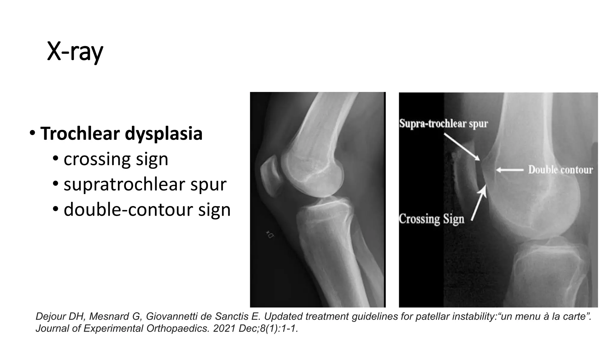 patellofemoral instability.pptx