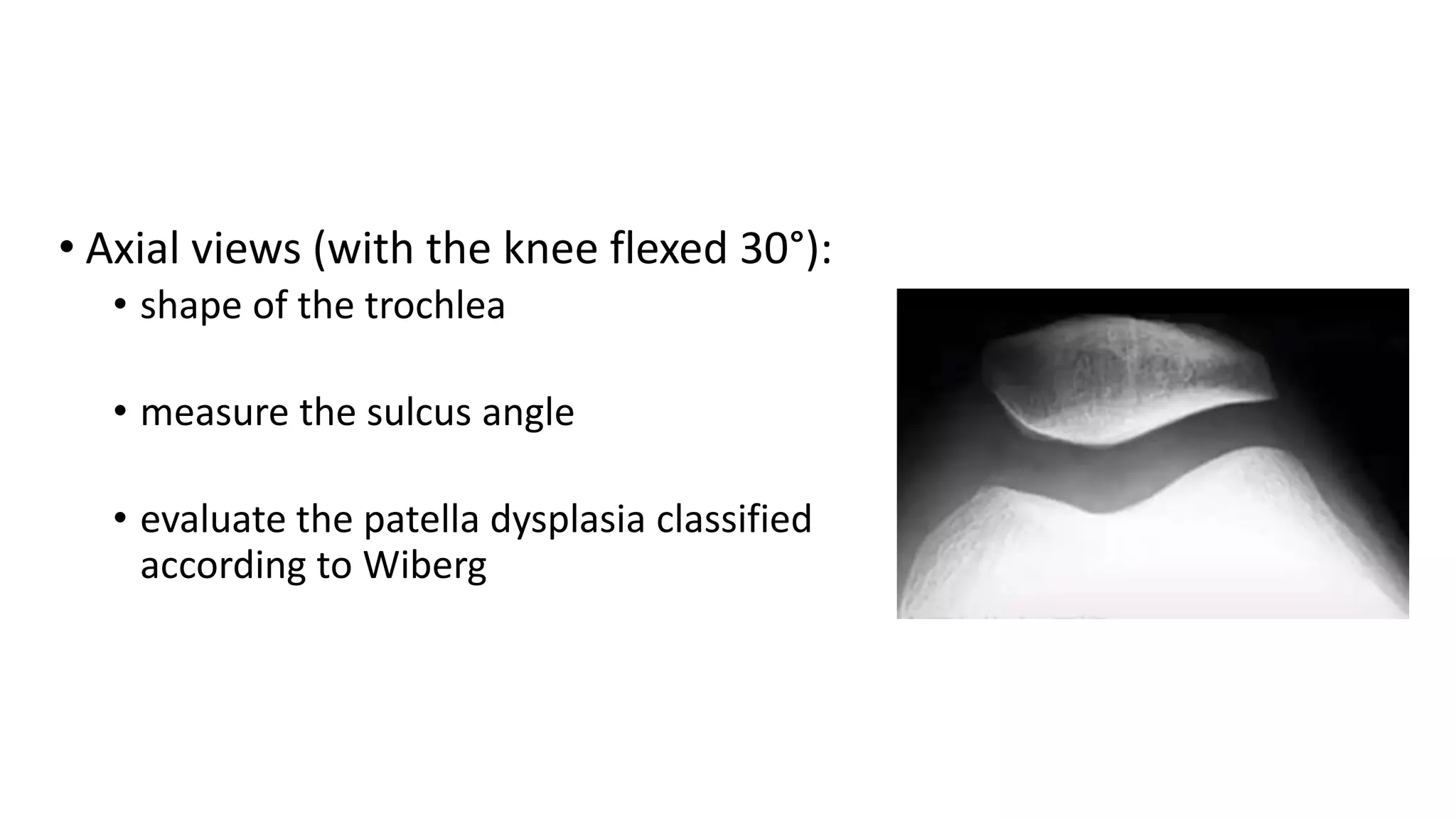 patellofemoral instability.pptx