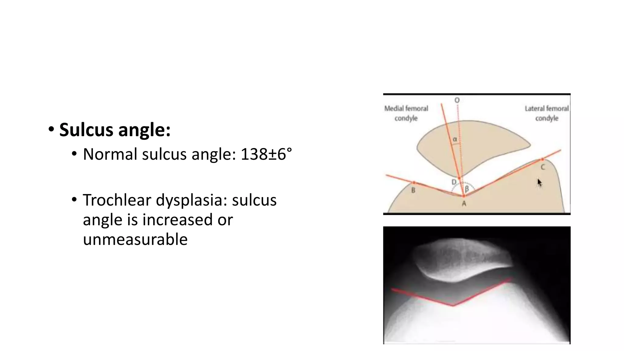 patellofemoral instability.pptx