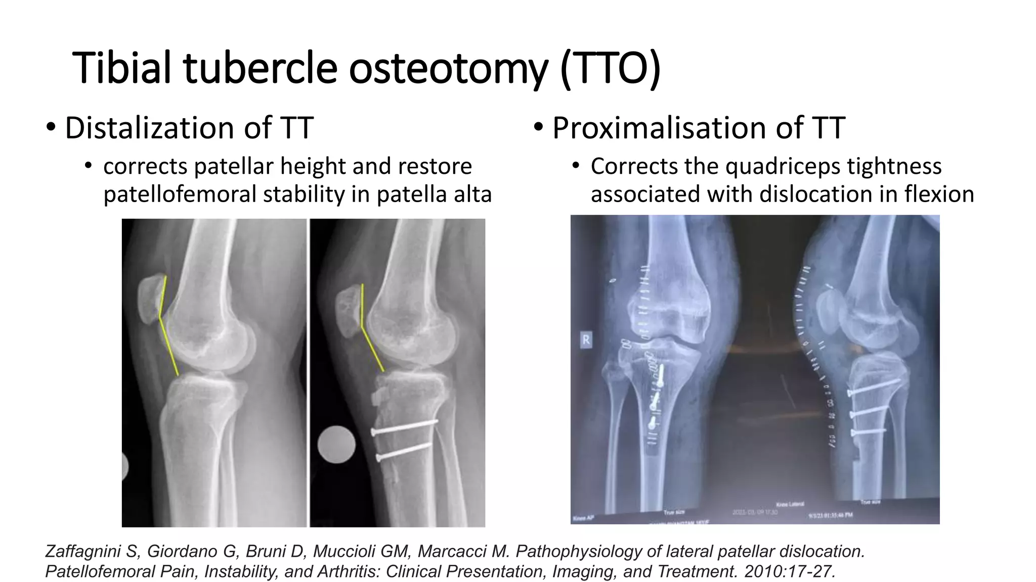 patellofemoral instability.pptx