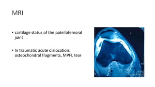 patellofemoral instability.pptx