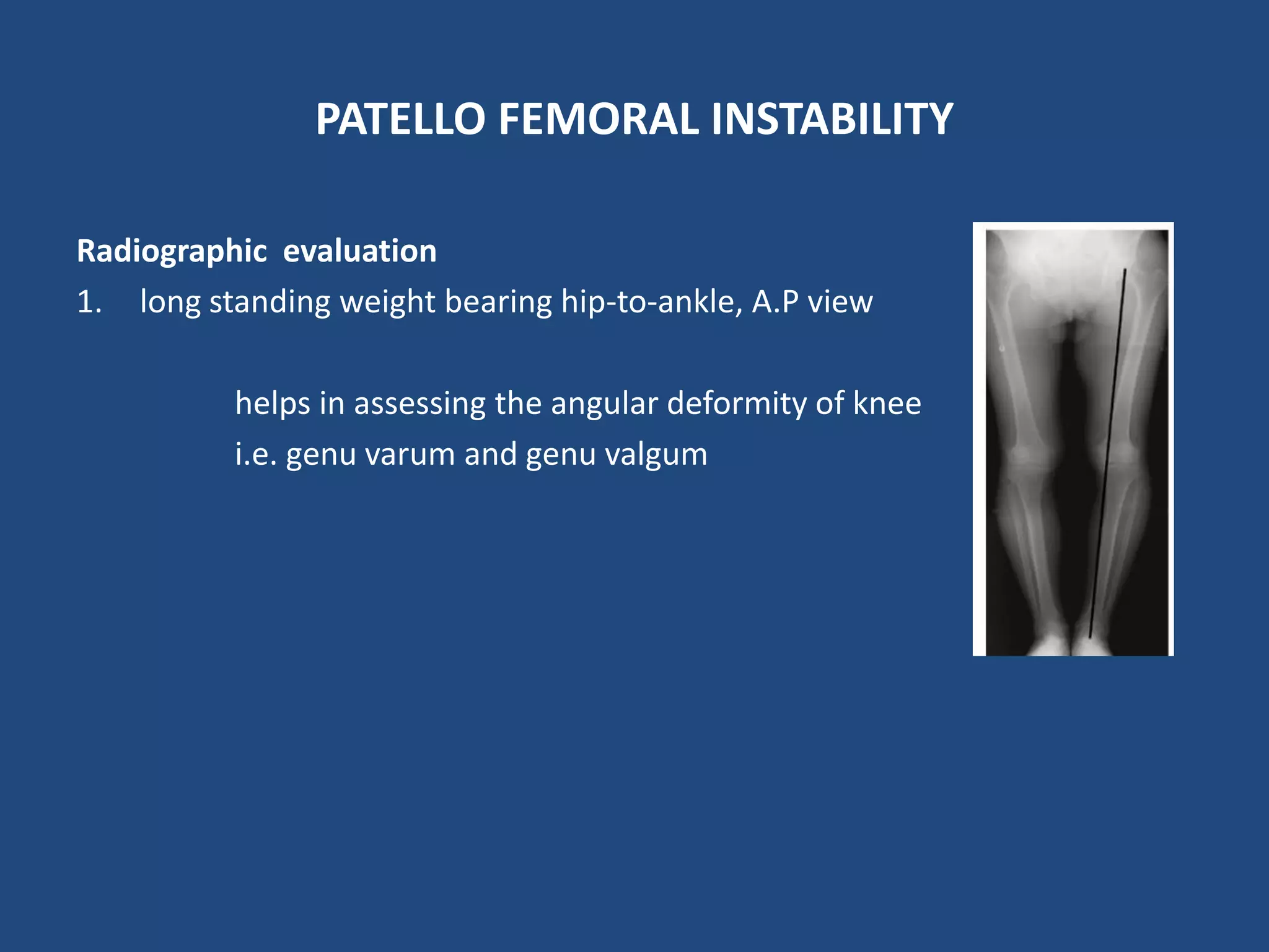 Patello femoral instability 22 | PPTX