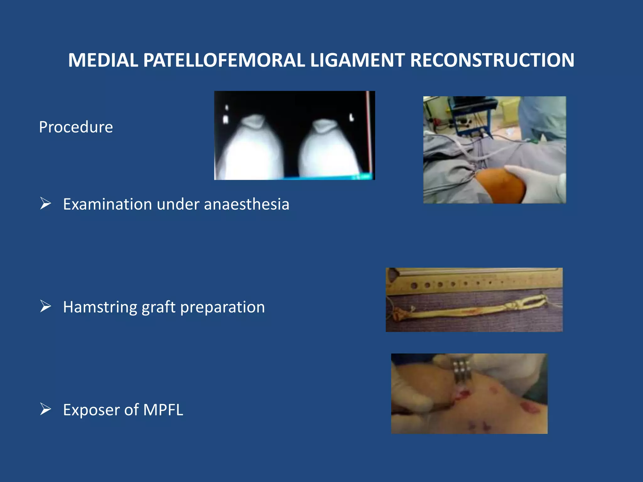 Patello femoral instability 22 | PPTX