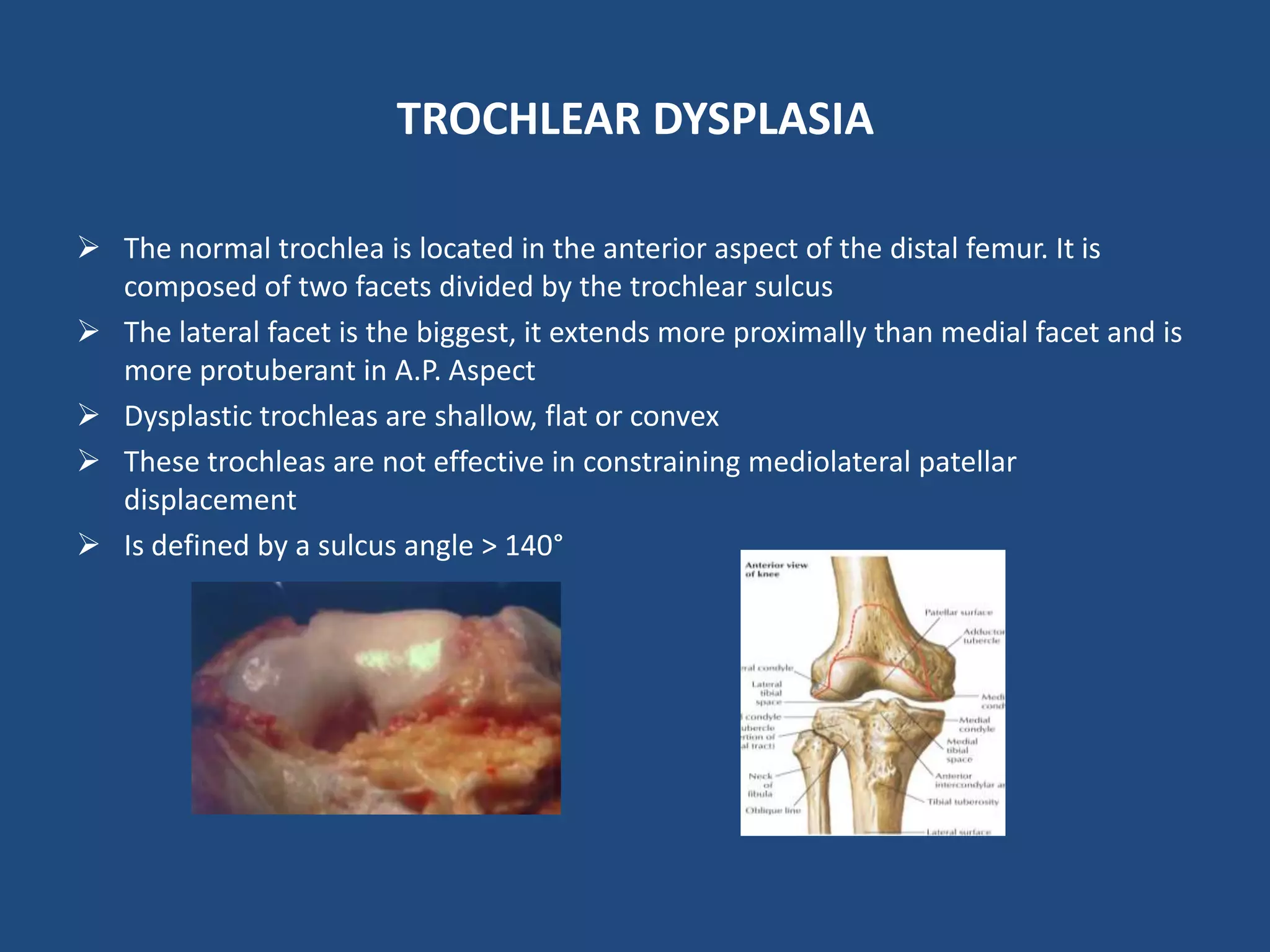 Patello femoral instability 22 | PPTX