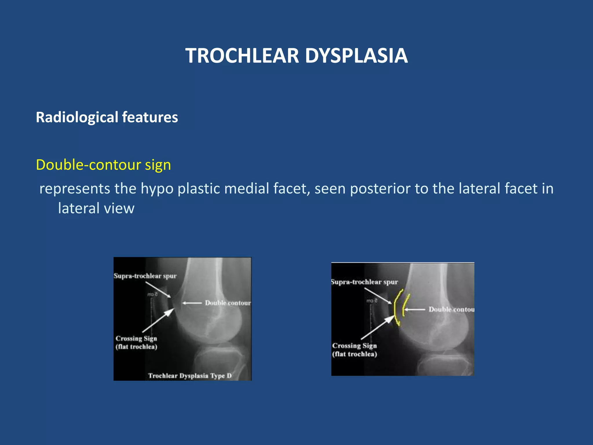 Patello femoral instability 22 | PPTX