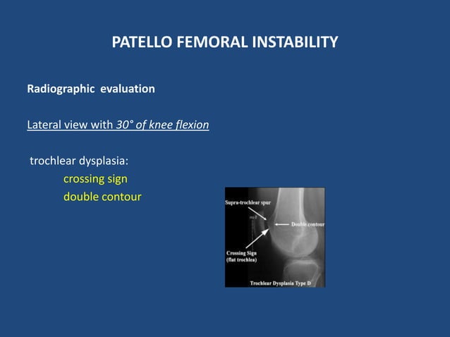 Patello femoral instability 22 | PPT