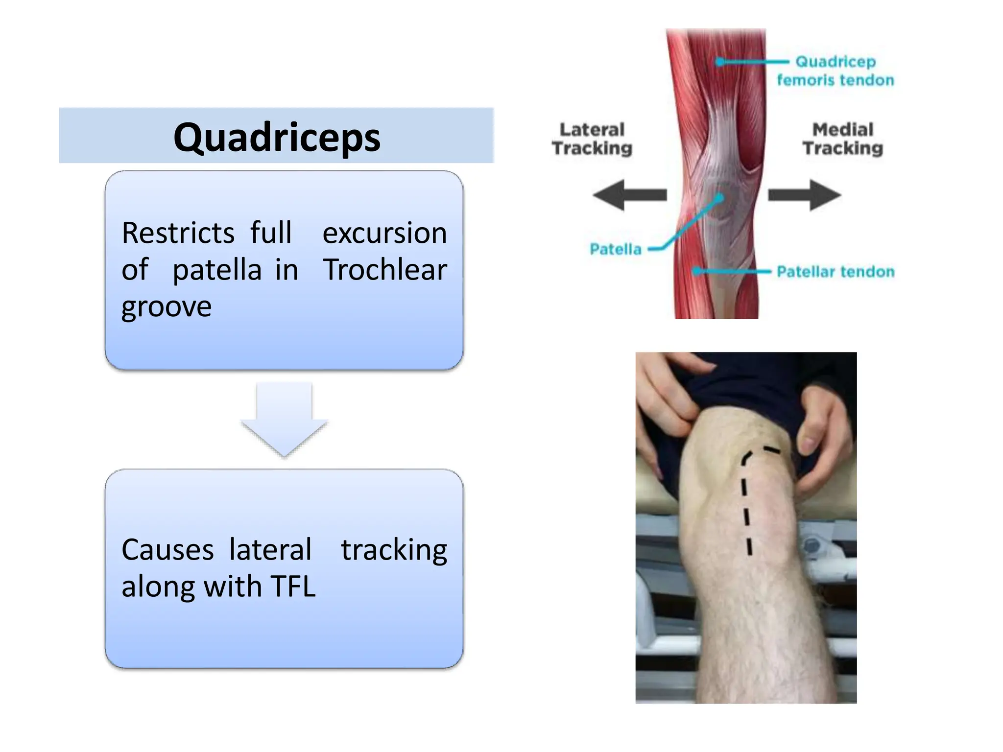 PATELLOFEMORAL PAIN (Harleen kaur Nagi).pptx