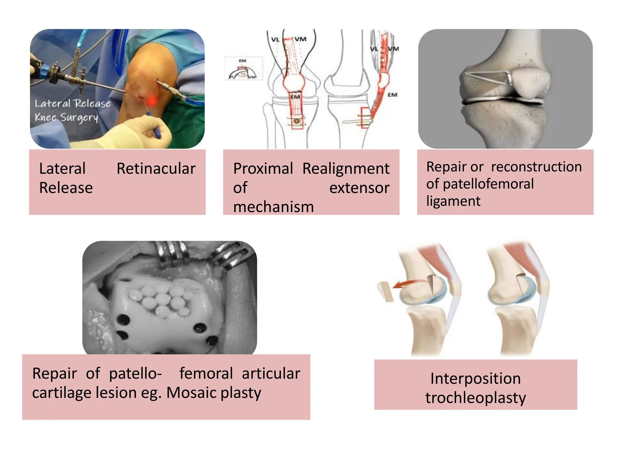 PATELLOFEMORAL PAIN (Harleen kaur Nagi).pptx