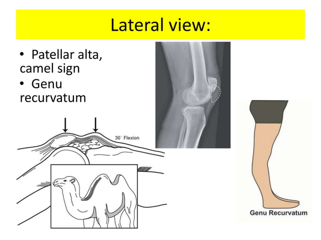 PATELLOFEMORAL PAIN (Harleen kaur Nagi).pptx