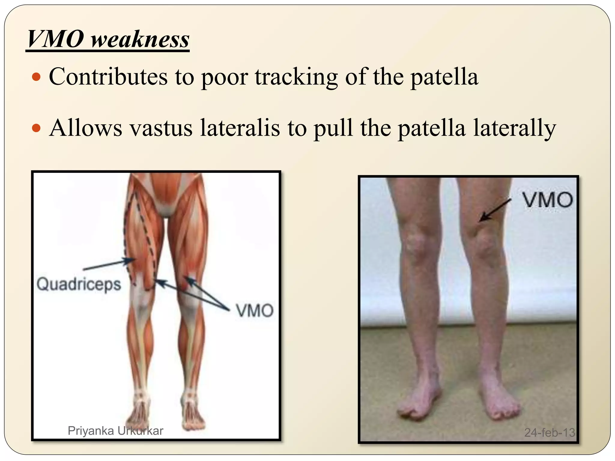 Patellofemoral pain syndrome (pfps) | PPTX | Death, Injury, or Military ...