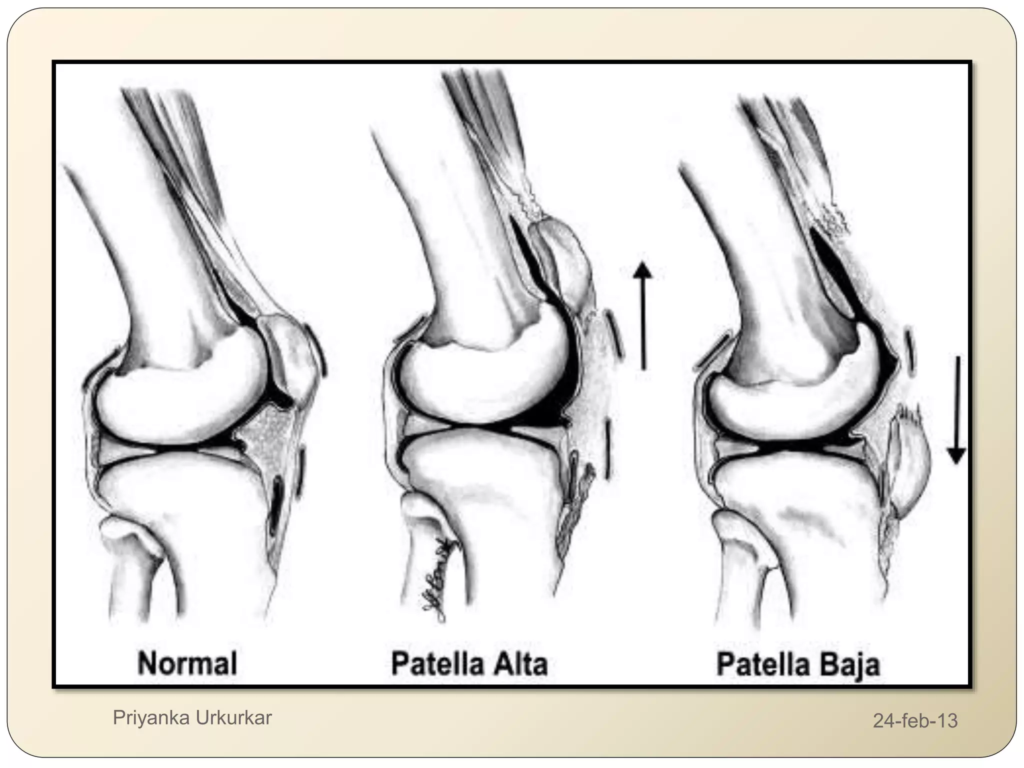 Patellofemoral pain syndrome (pfps) | PPTX