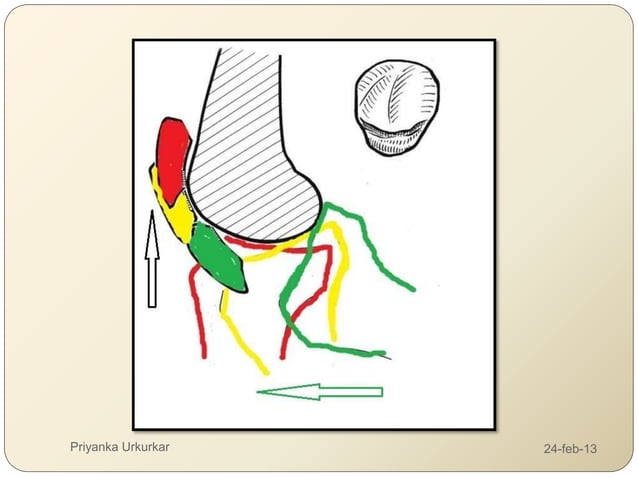 Patellofemoral pain syndrome (pfps) | PPTX | Death, Injury, or Military ...