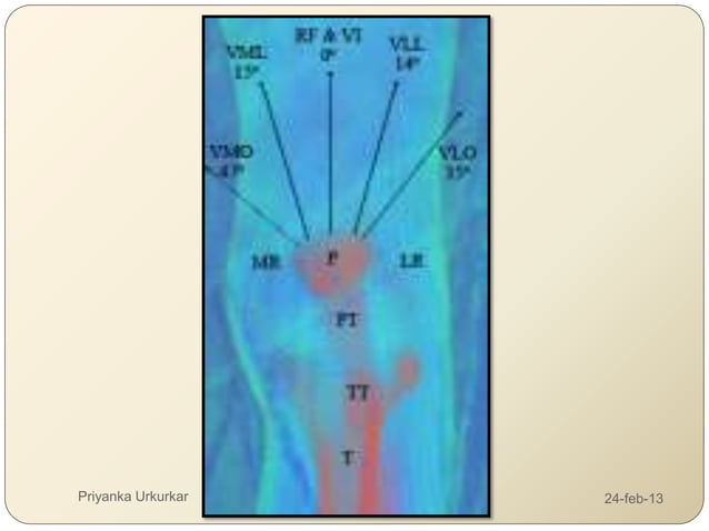Patellofemoral pain syndrome (pfps) | PPTX | Death, Injury, or Military ...