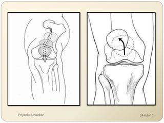 Patellofemoral pain syndrome (pfps) | PPT