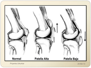 Patellofemoral pain syndrome (pfps) | PPT