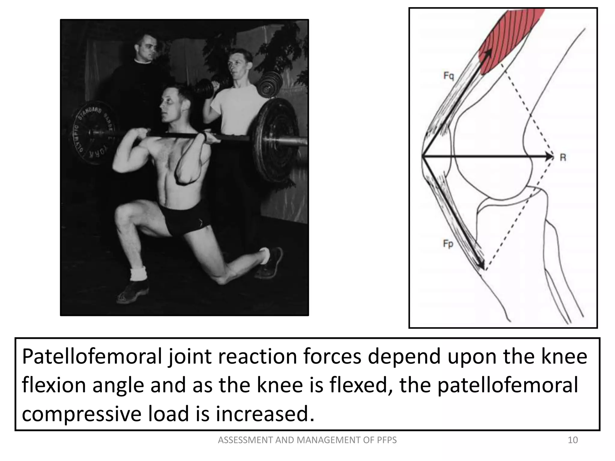 Patellofemoral pain syndrome (pfps) | PPTX