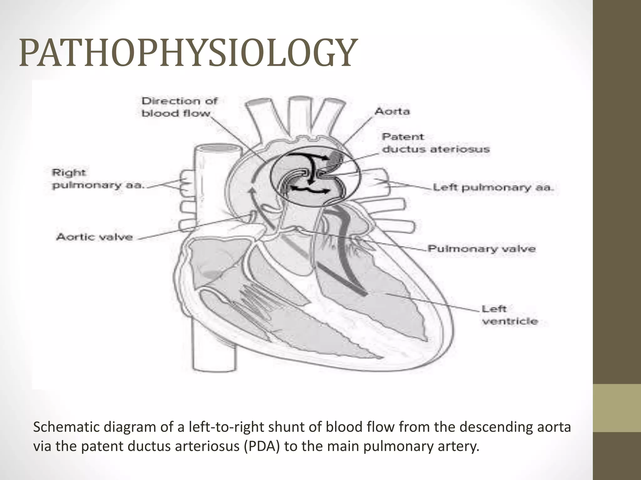 Patent-Ductus-Arteriosis-Discuss.pptx
