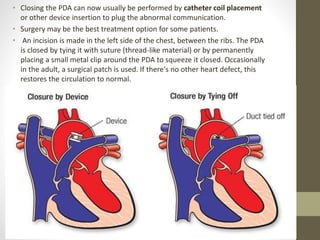 Patent-Ductus-Arteriosis-Discuss.pptx