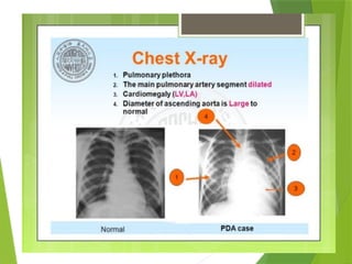 PATENT DUCTUS ARTERIOSUS- clinical features and pathophysiology | PPTX