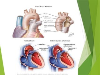 PATENT DUCTUS ARTERIOSUS- clinical features and pathophysiology | PPTX