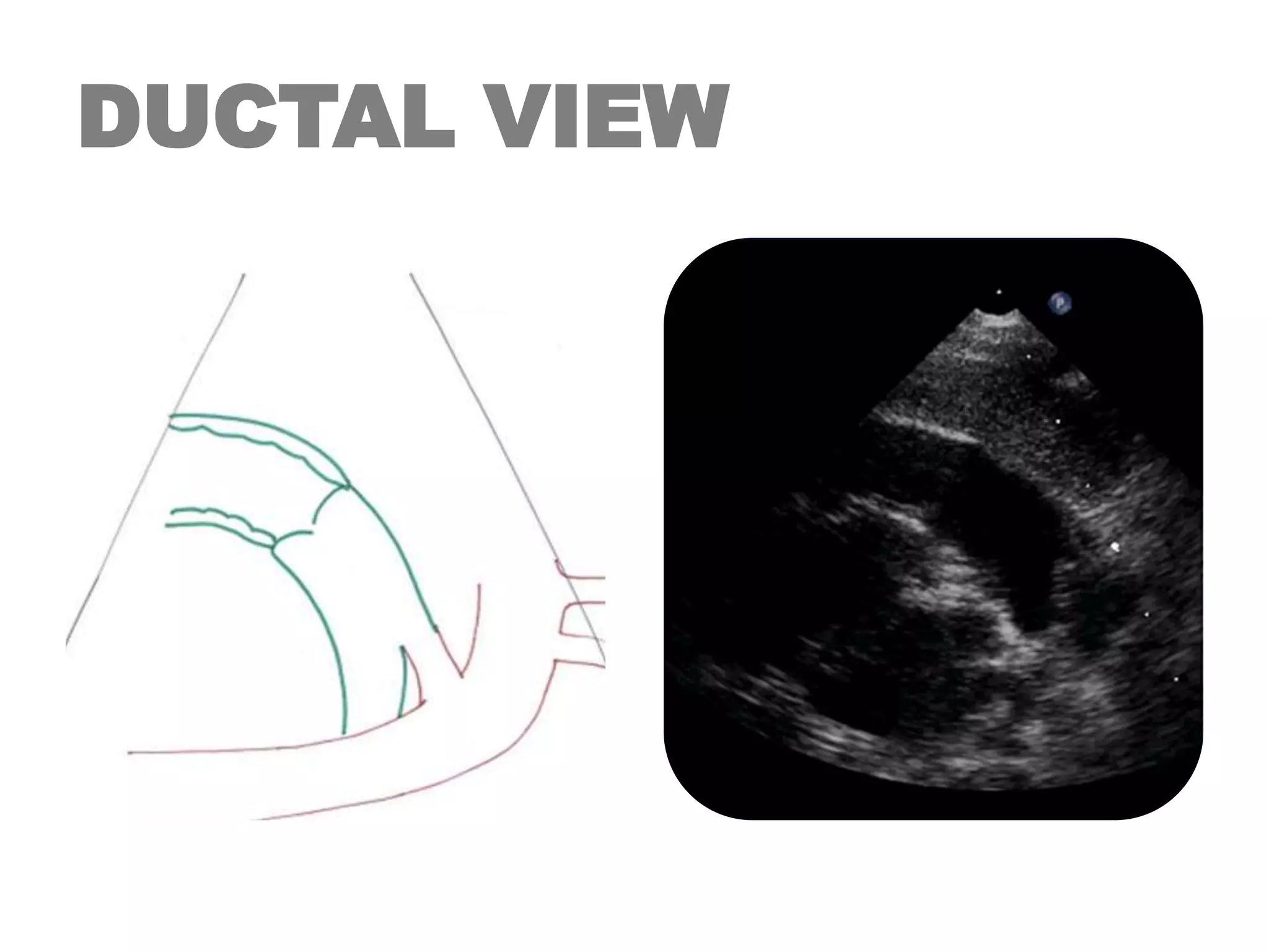 Patent ductus arteriosis types evaluation and management (2) | PPTX