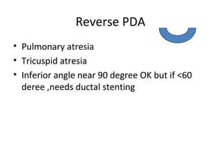 Patent ductus arteriosus | PPT