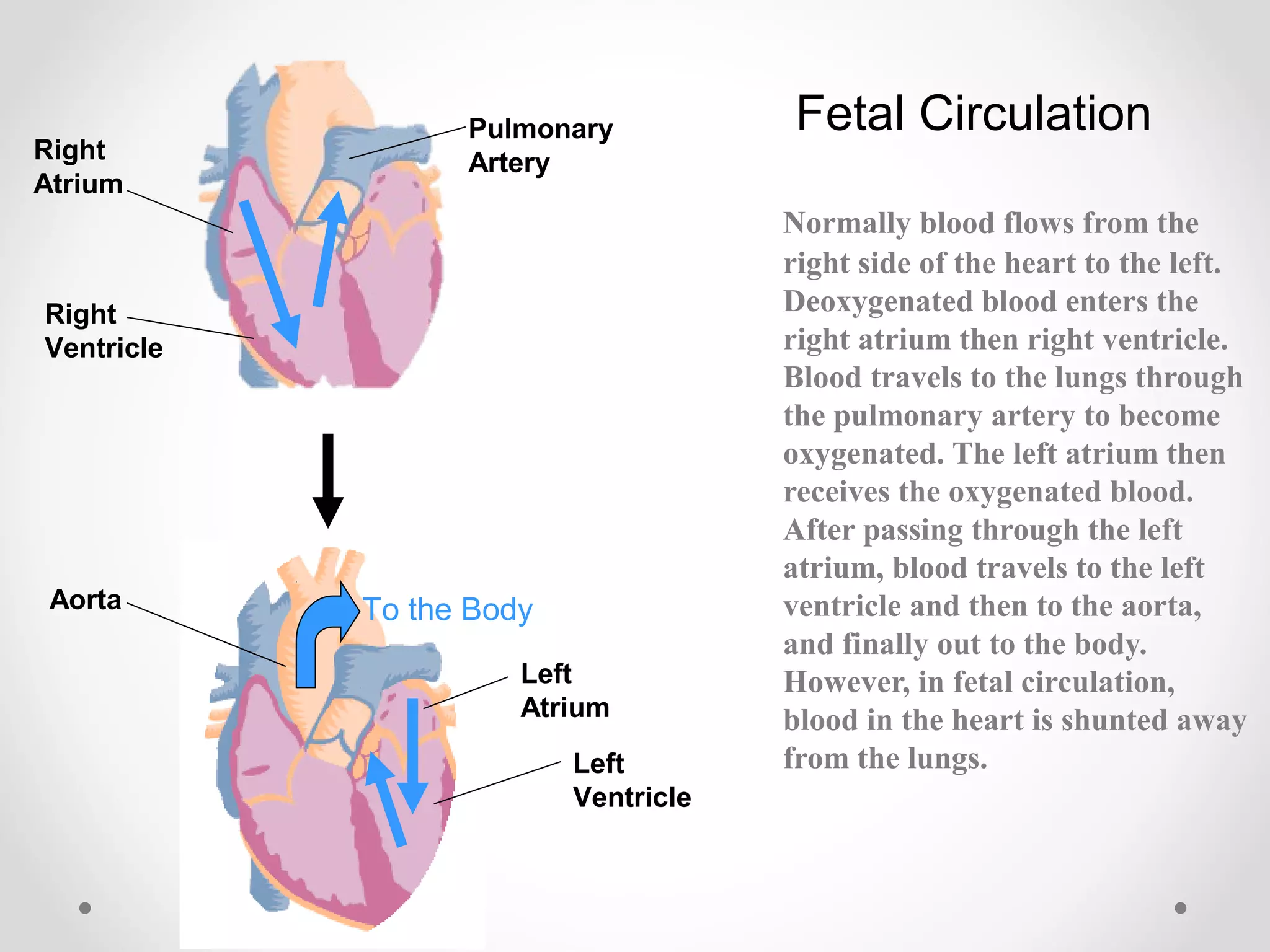 Patent Ductus Arteriosus | PPT