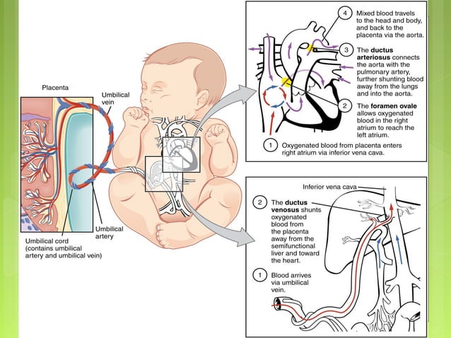 Patent ductus arteriosus | PPT | Heart and Cardiovascular Diseases ...