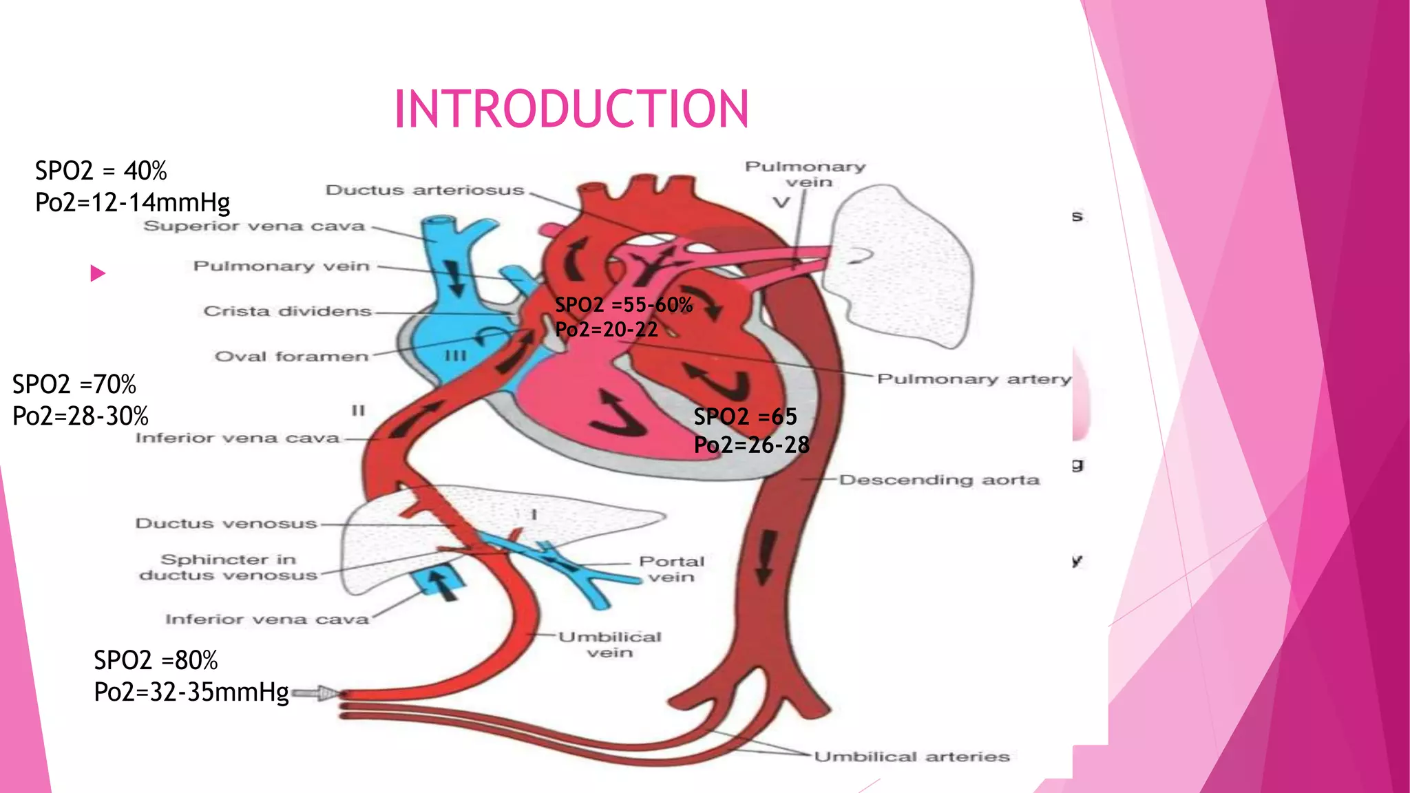 Patent ductus arteriosus | PPTX