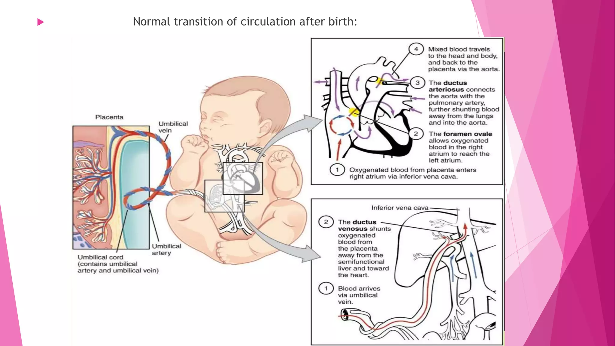 Patent ductus arteriosus | PPTX