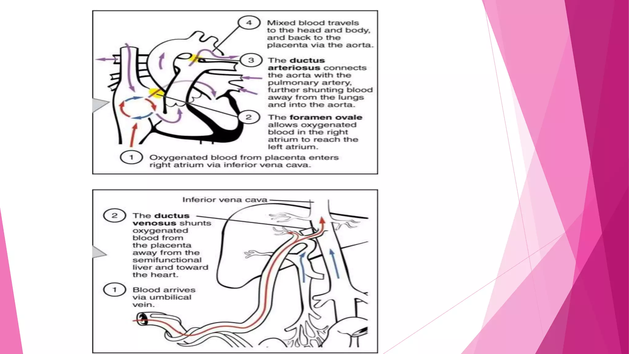 Patent ductus arteriosus | PPTX